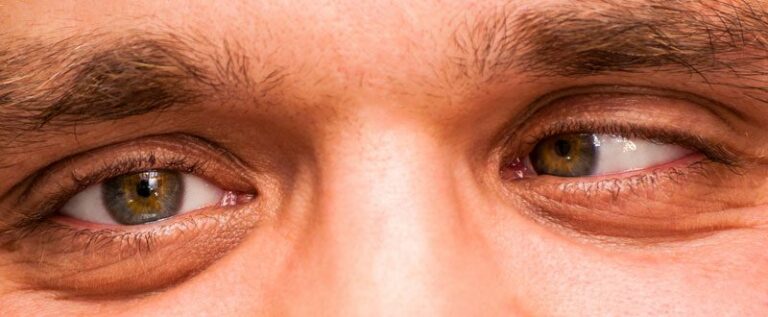 Adult Strabismus Surgery: Causes, Treatment, and Recovery Experiences