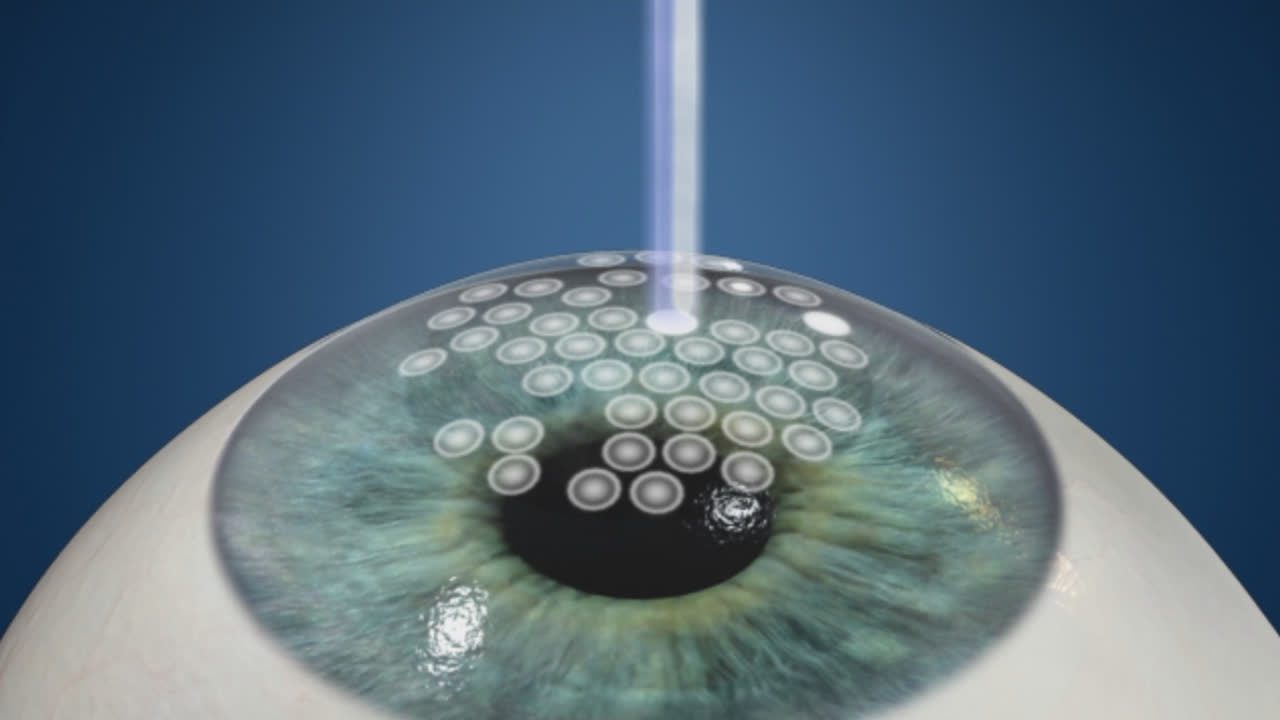 PRK Laser Eye Surgery: Benefits, Procedure, Recovery & Vision Correction