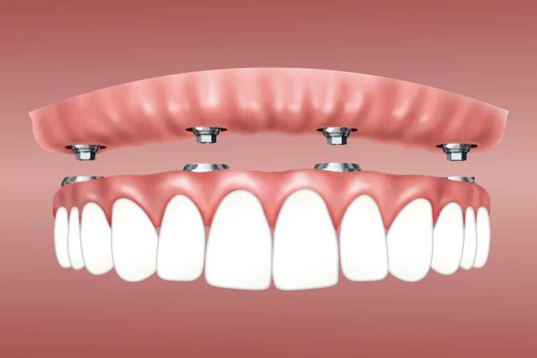 Types of Dental Prostheses: Fixed, Removable & How to Care for Them