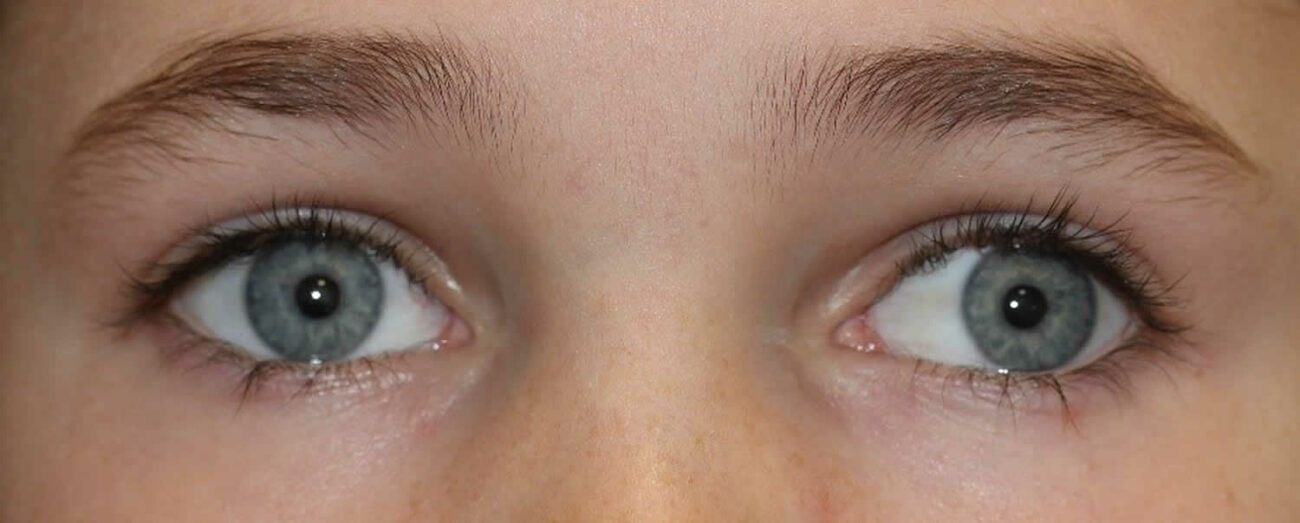 Does Strabismus Get Worse Over Time? Causes, Symptoms & Treatment (2026)