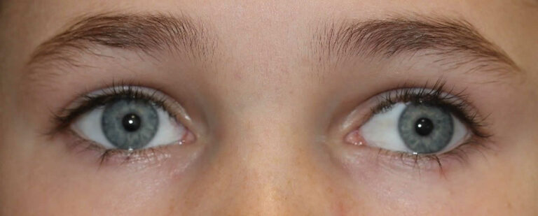 Does Strabismus Get Worse Over Time? Causes, Symptoms & Treatment (2026)