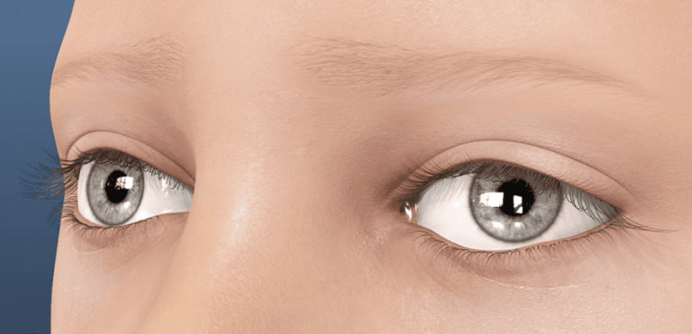 Amblyopia Treatment in Adults – Causes, Types, Symptoms, and Solutions