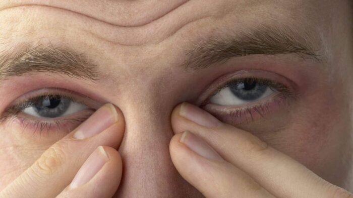 Nasolacrimal Duct Obstruction in Adults: Symptoms, Causes, Risk Factors ...