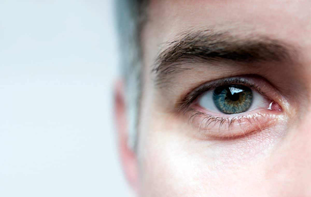 Under-Eye Bags: Causes, Symptoms, Diagnosis & Treatment