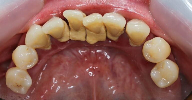 Periodontal Pockets: Causes, Treatment, Prevention & Risk Factors