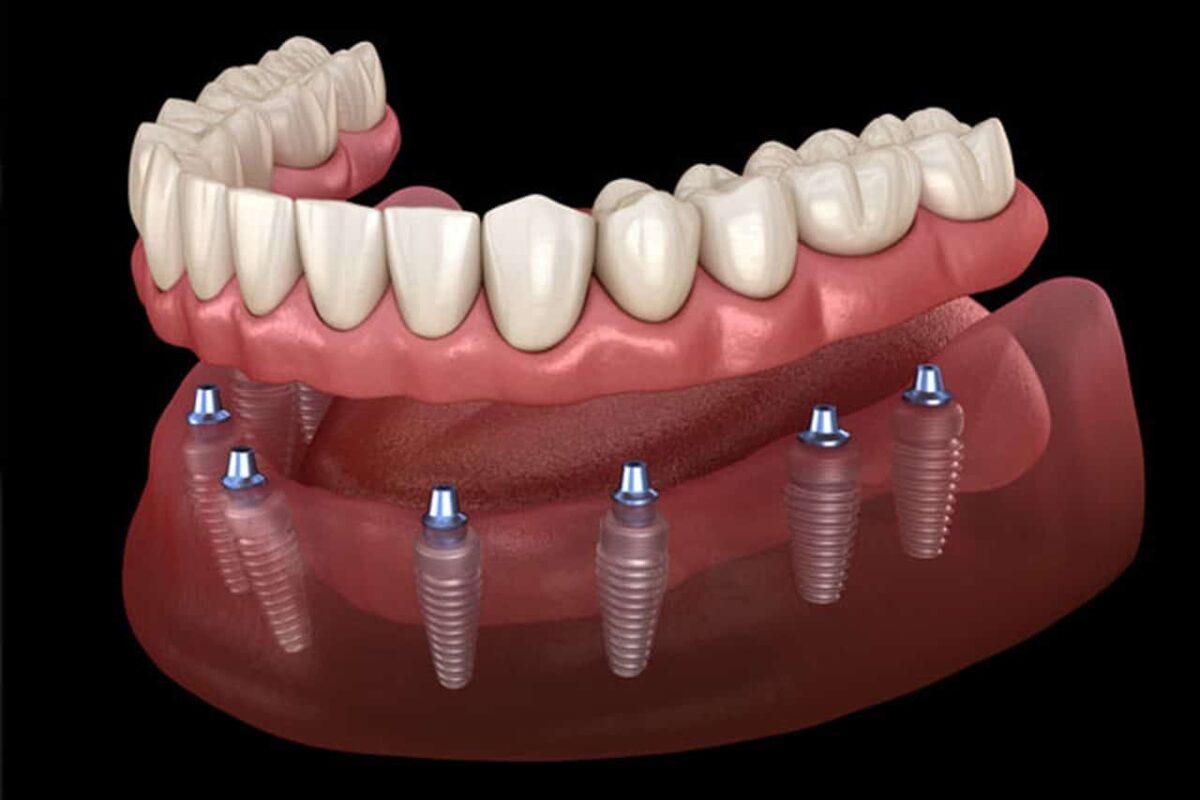 Dental Implants vs Dentures – Key Differences, Benefits & Costs