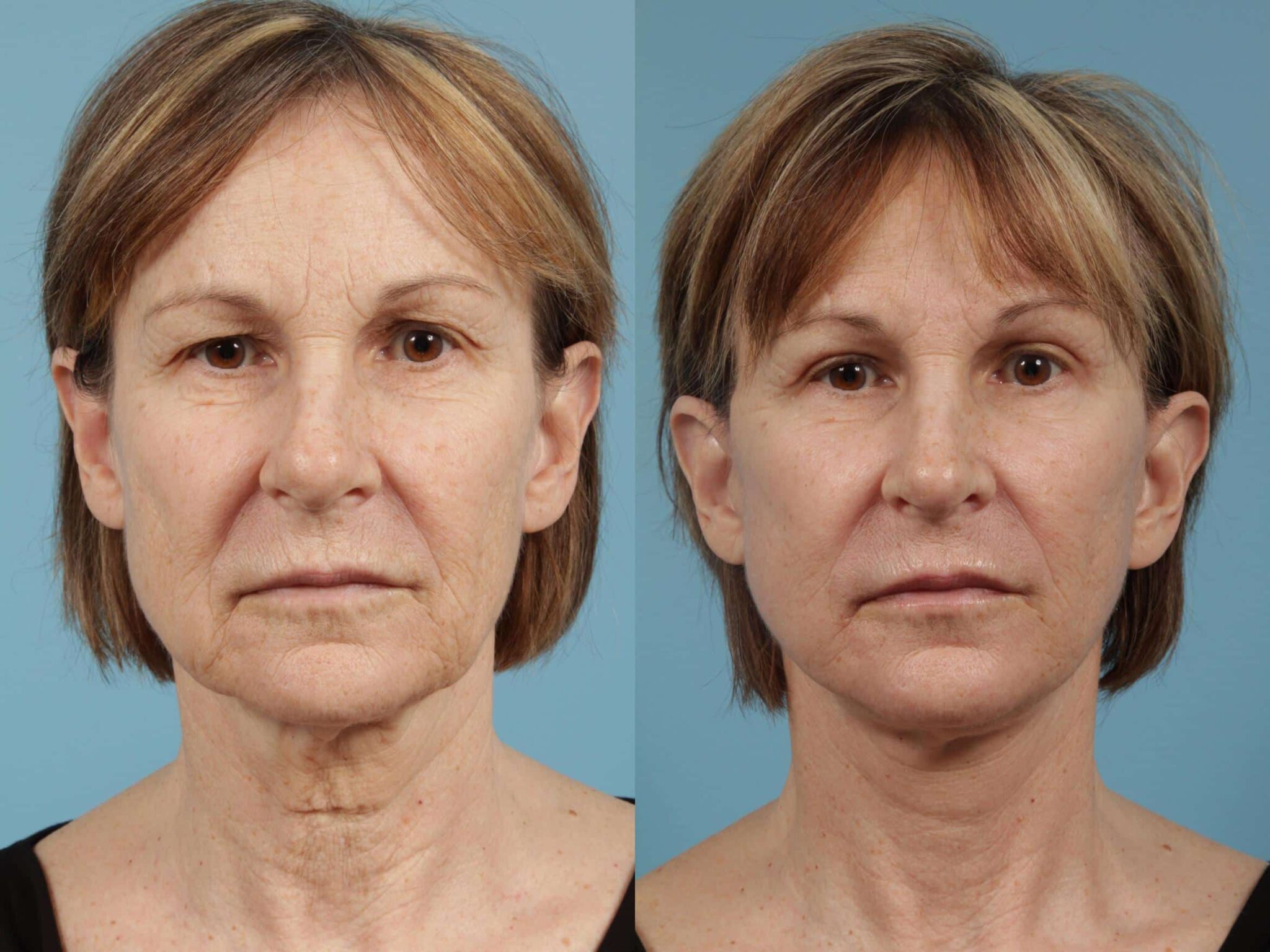 Before and After Eye Treatment Photos | Strabismus, Glaucoma, and LASIK ...