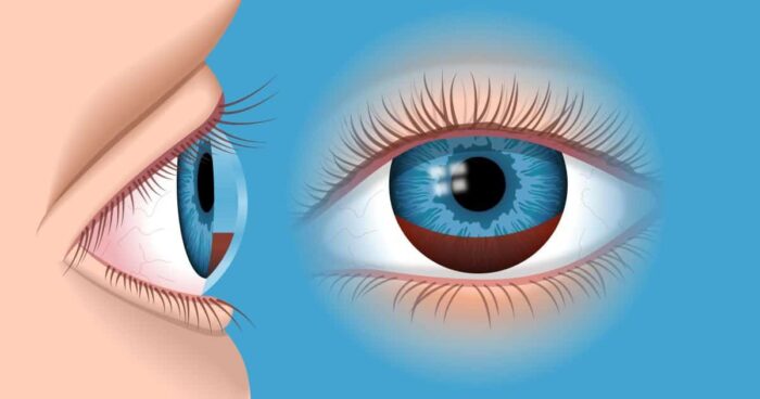Hyphema in the Eye: Causes, Symptoms, Diagnosis & Treatment