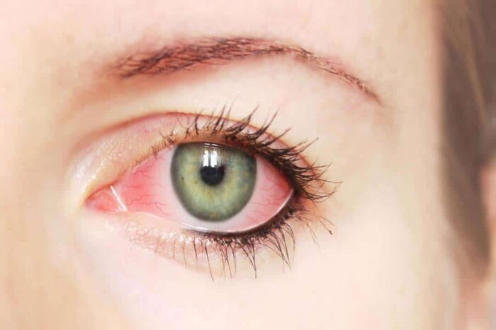 Subconjunctival Hemorrhage: Causes, Symptoms, Diagnosis, and Treatment