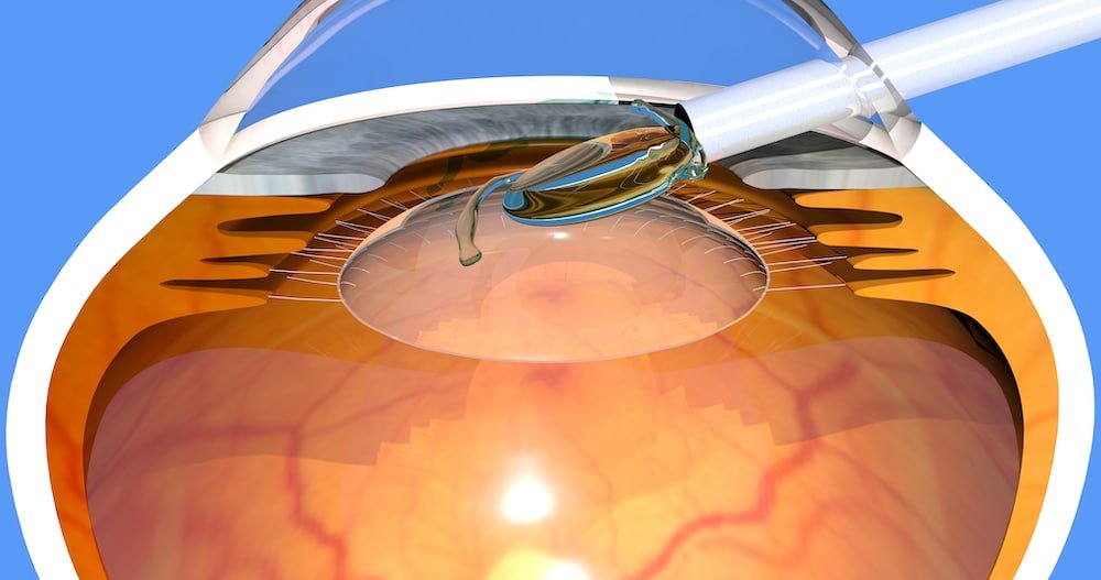 Intraocular Lens Implantation: Procedure, Types, and Candidacy Explained