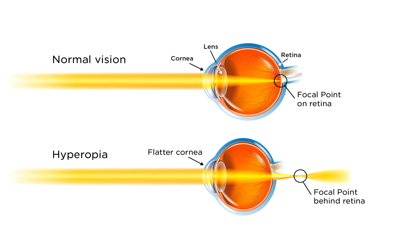 Hyperopia (Farsightedness): Causes, Symptoms, and Treatment Options