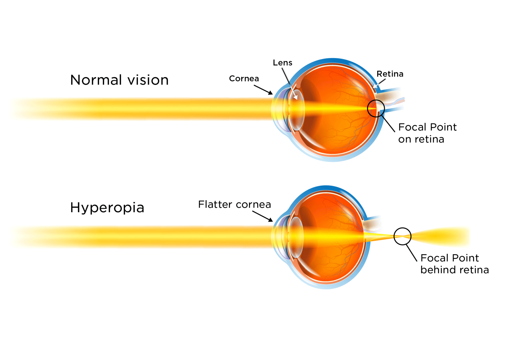 Hyperopia (Farsightedness): Causes, Symptoms, and Treatment Options