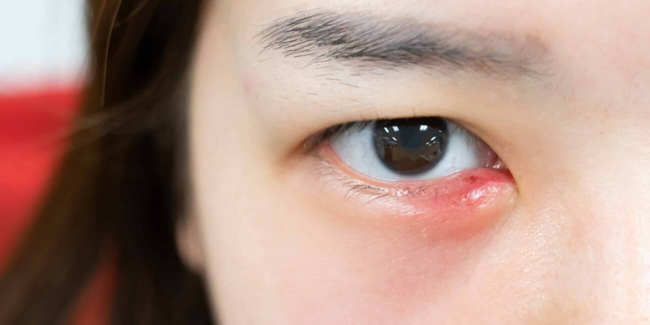 Stye (Hordeolum): Causes, Symptoms, Diagnosis, and Treatment