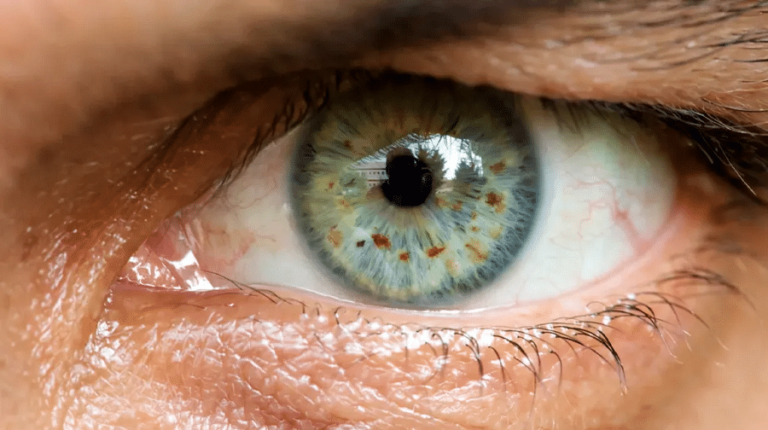 Eye Freckles: Causes, Symptoms, Types, and Treatment Options