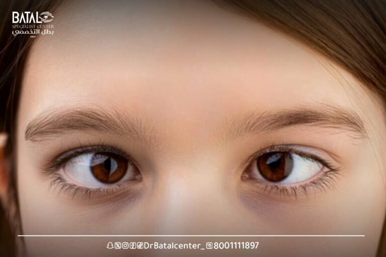 Simple Strabismus: Causes, Symptoms & Best Treatment Options at Batal ...