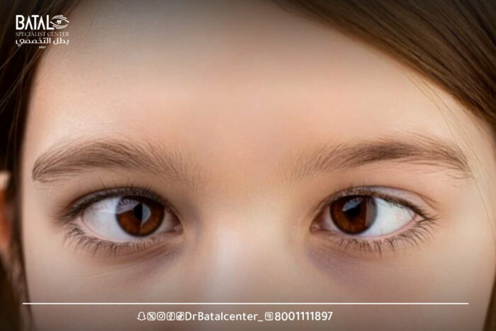 Simple Strabismus: Causes, Symptoms & Best Treatment Options at Batal Eye Center