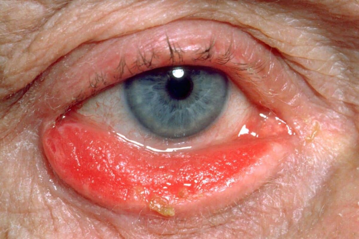 Types of Eyelid Surgery Explained in Detail | Procedures, Benefits and ...