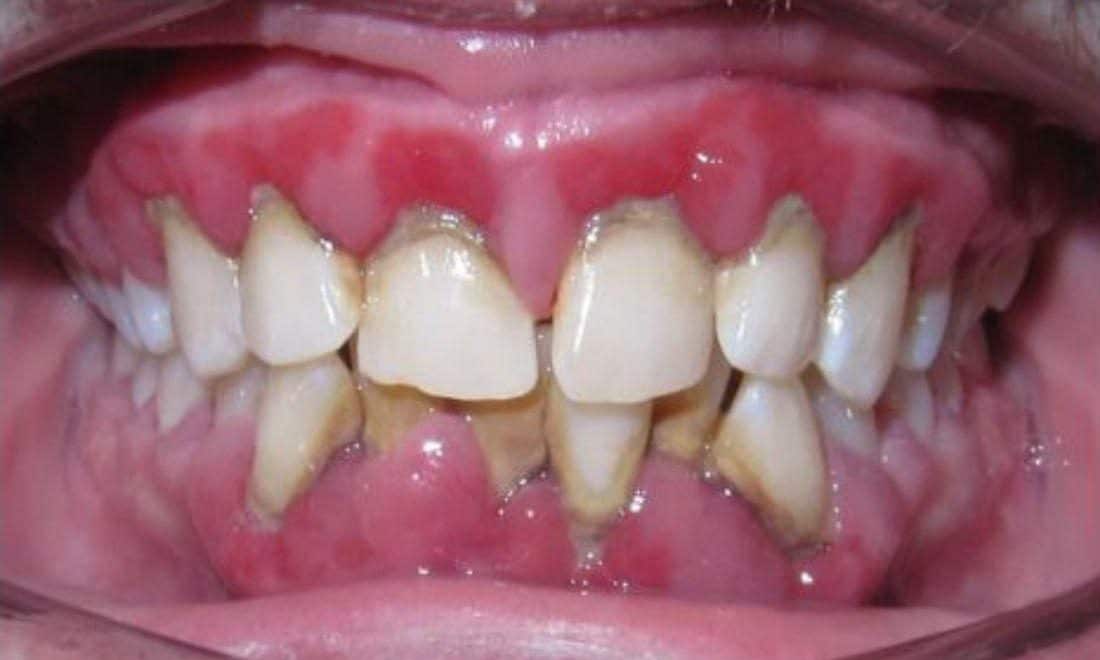 Dental Abscess Treatment: Causes, Symptoms, and Pictures Explained