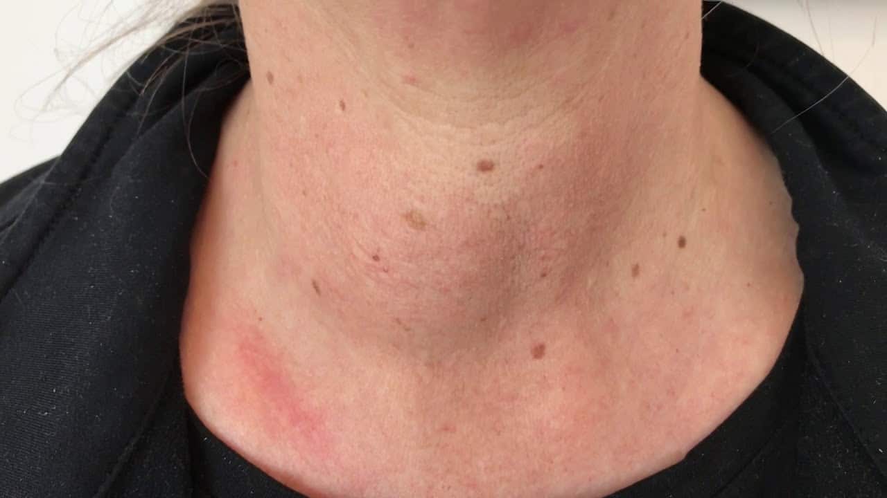 Thyroid Nodules: Causes, Symptoms, Diagnosis, and Treatment Explained