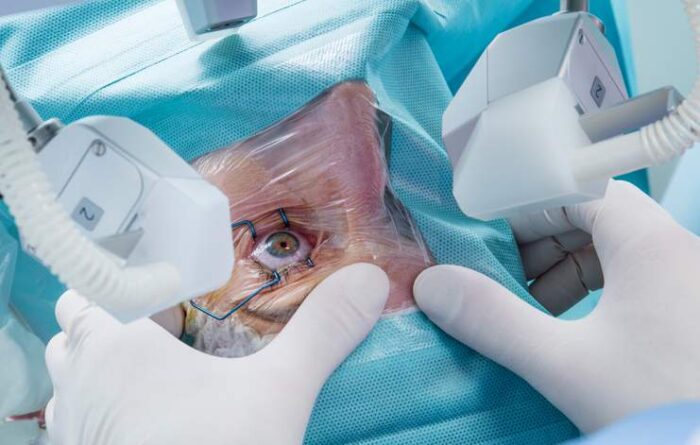 Is PRK Vision Correction Permanent? Procedure, Benefits, and Recovery Guide