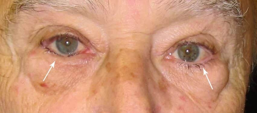 Entropion Repair: Causes, Symptoms, Treatment Options, and Surgery