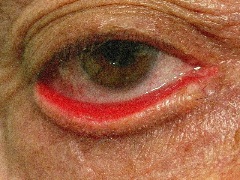 Ectropion: Causes, Symptoms, Treatment, and Complications Explained