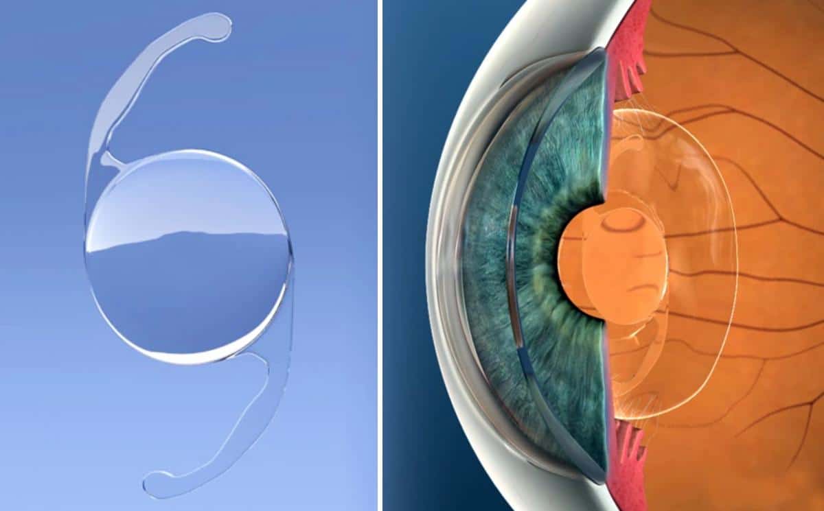 Lens Replacement Surgery: When It’s Needed, Benefits, Risks & Costs ...